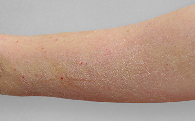 DUPIXENT Starter Kit